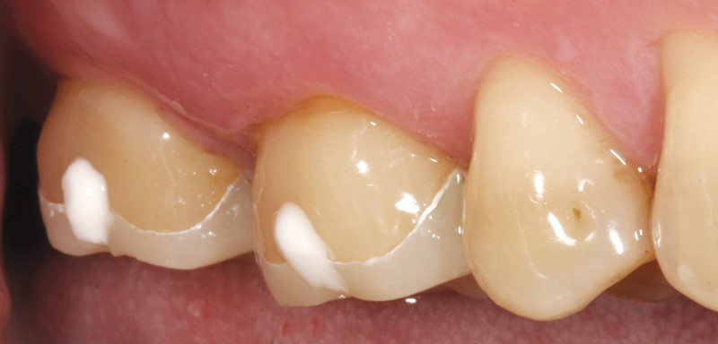 Inlays et onlays en céramique : critères de succès – L'Information Dentaire