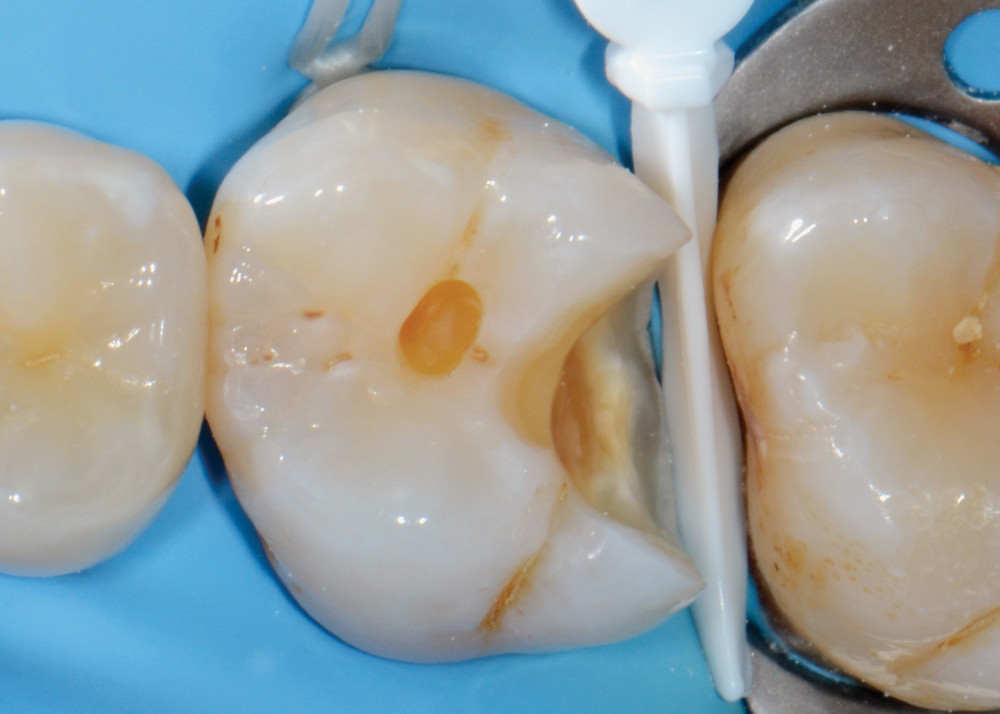 Le coin et l’anneau – L'Information Dentaire