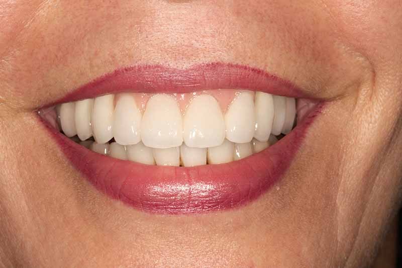 Incidence du support labial sur la décision thérapeutique en prothèse ...