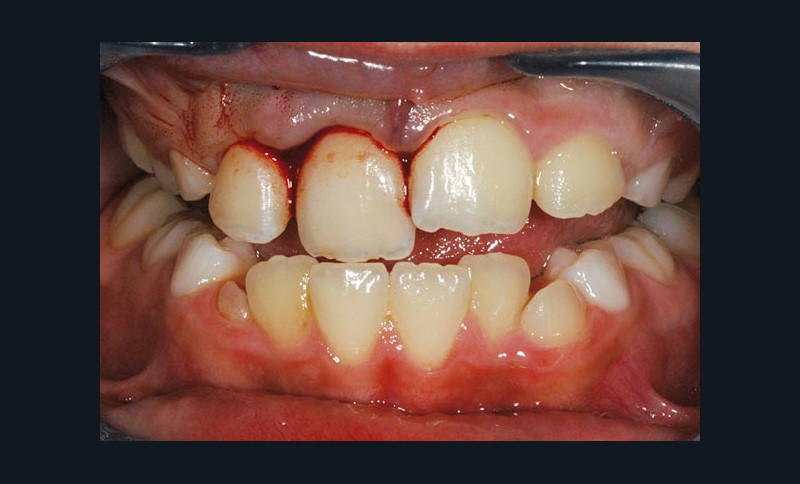 Les fractures radiculaires des dents permanentes – L'Information Dentaire