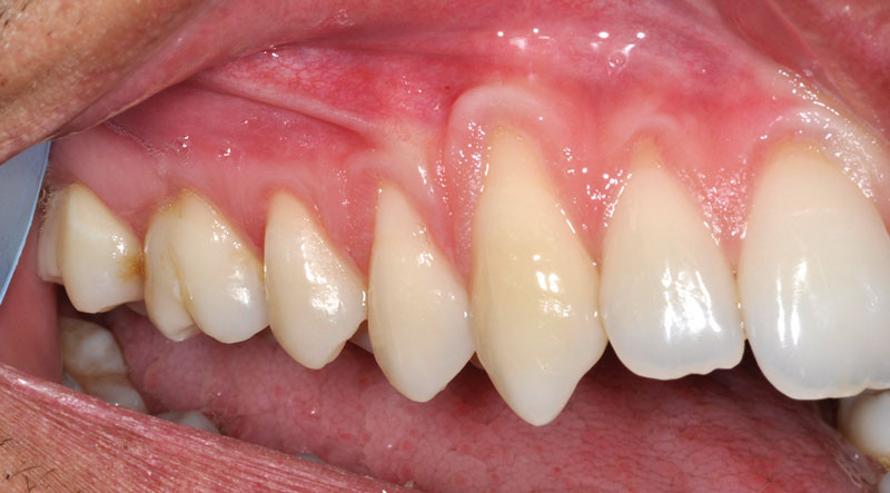 Reconstruire le parodonte marginal chez le sujet jeune – L'Information ...