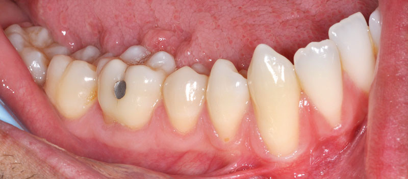 Reconstruire le parodonte marginal chez le sujet jeune – L'Information ...