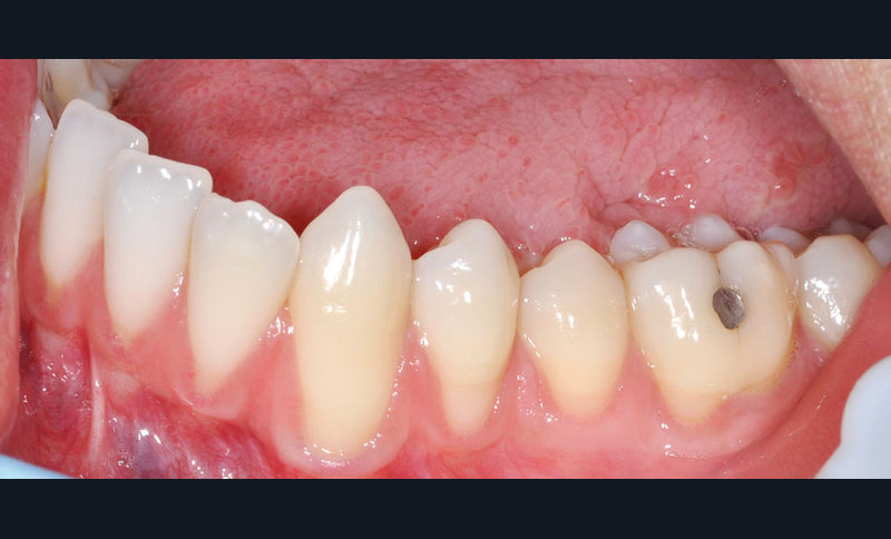 Reconstruire le parodonte marginal chez le sujet jeune – L'Information ...