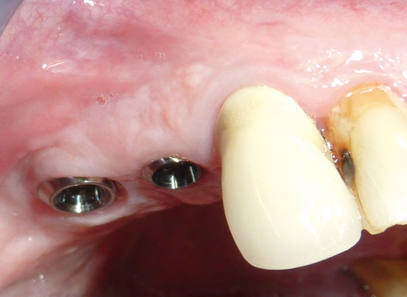 Intérêt des implants à col transgingival long dans les situations de ...