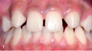 Du bridge collé à l’implant 3.0 dix ans de traitement – L'Information ...