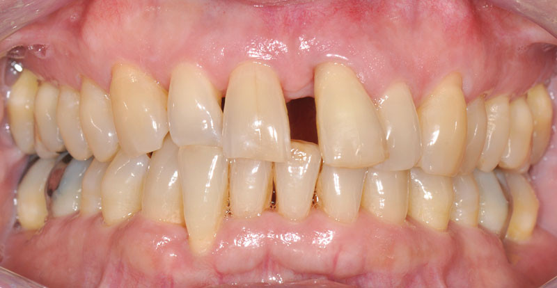 Parodontie et orthodontie : le traitement idéal des maladies ...