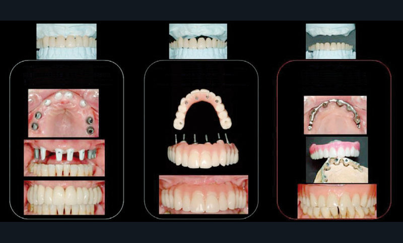 La prothèse amovible complète maxillaire stabilisée sur implants – L ...