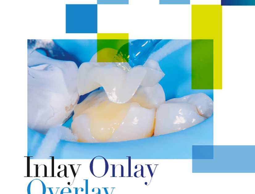 Concepts. Inlay, Onlay, Overlay – L'Information Dentaire