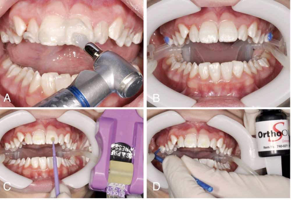 Protocole de collage indirect recommandé pour la préservation de l ...