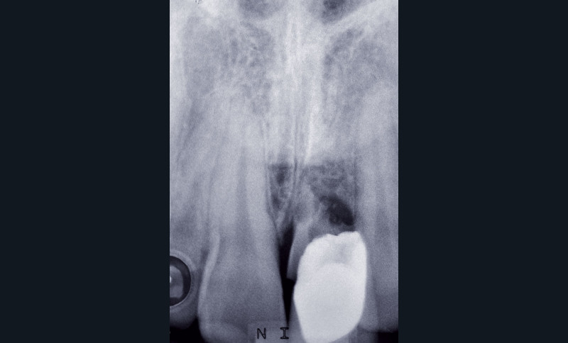 Dynamique tissulaire et esthétique implantaire : à propos d’un cas d ...
