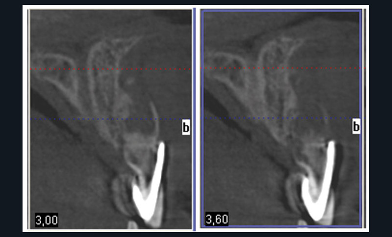 Dynamique tissulaire et esthétique implantaire : à propos d’un cas d ...