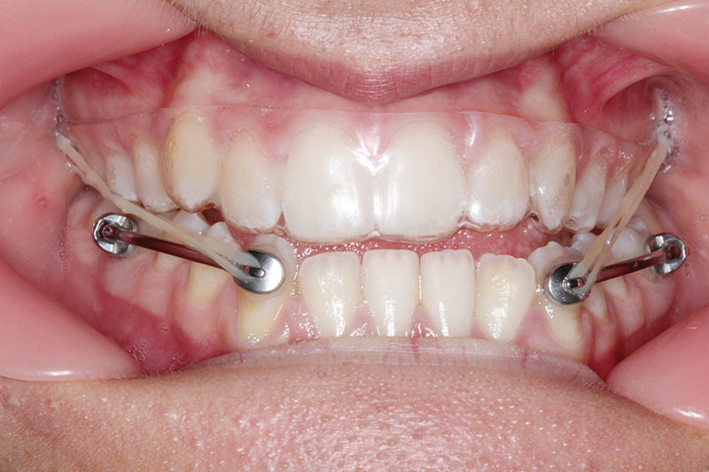 Utilisation thérapeutique du Motion Carriere – L'Information Dentaire