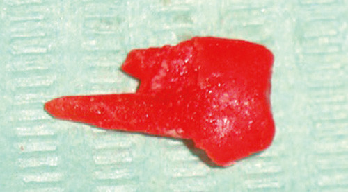 Inlay core par technique directe : quand et comment ? – L'Information ...