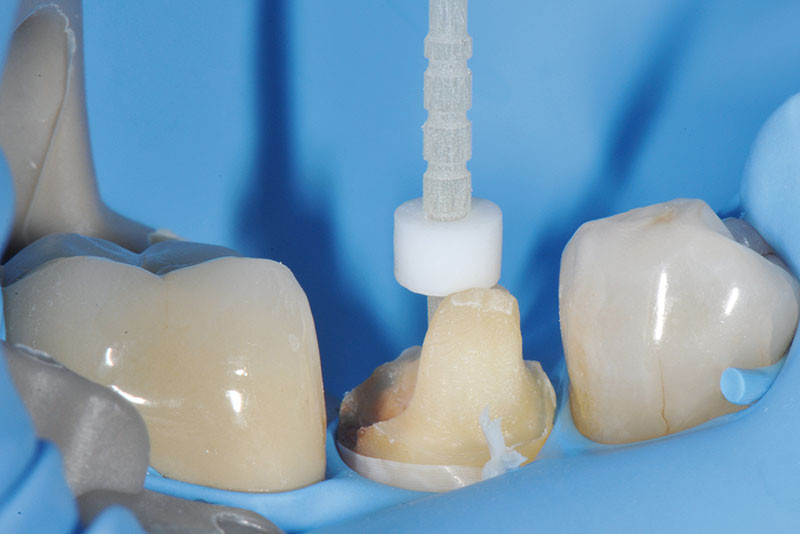 Mise en œuvre d’une reconstitution par tenon fibré et composite (RMIPP ...