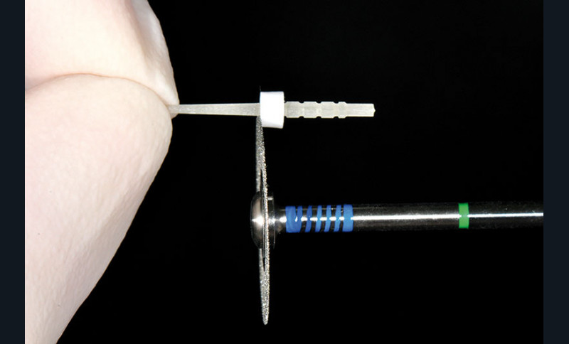 Mise en œuvre d’une reconstitution par tenon fibré et composite (RMIPP ...