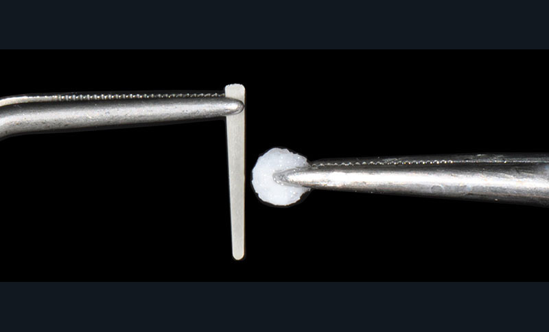 Mise en œuvre d’une reconstitution par tenon fibré et composite (RMIPP ...