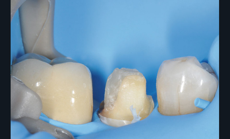 Mise en œuvre d’une reconstitution par tenon fibré et composite (RMIPP ...