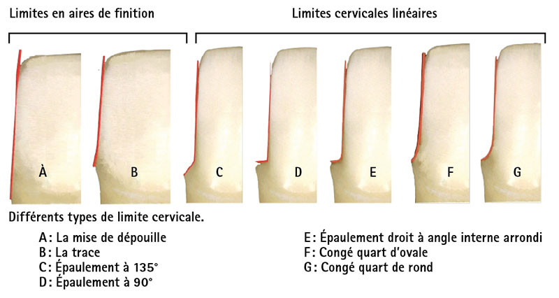 Préparation pour coiffes céramo-métalliques et céramo-céramiques – L ...