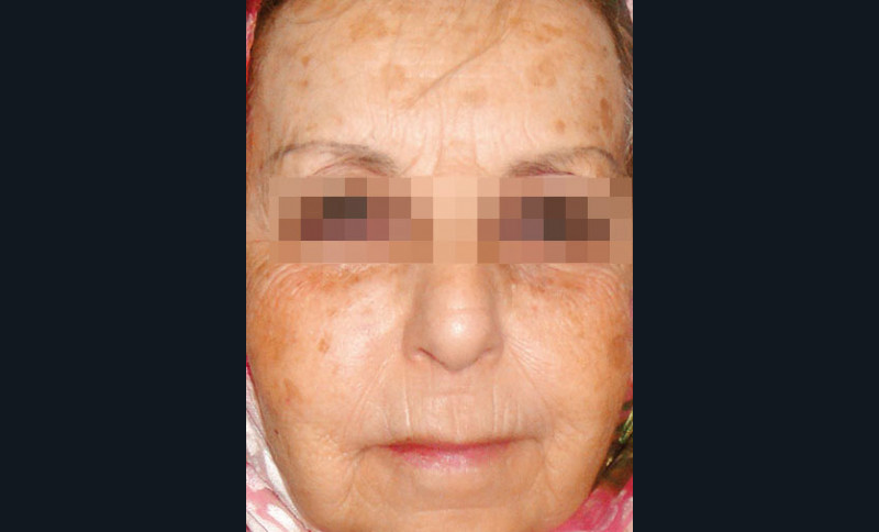 La prothèse composite dans la gestion esthétique et biomécanique d’un ...