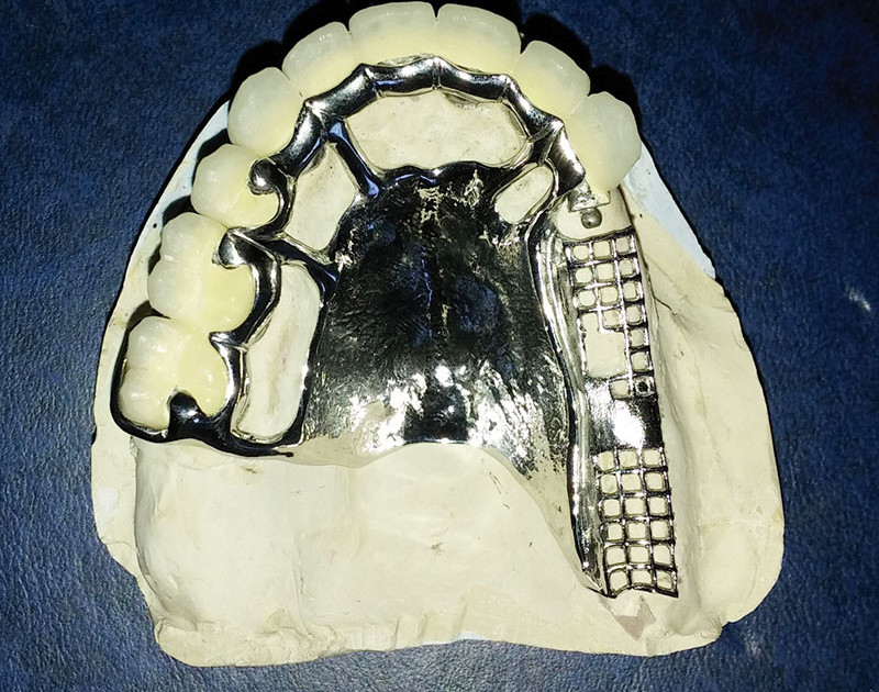 La prothèse composite dans la gestion esthétique et biomécanique d’un ...