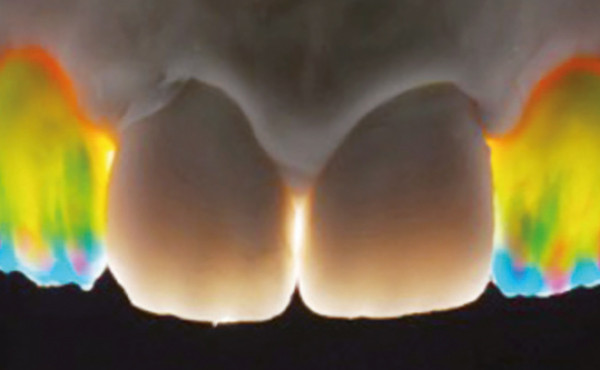 Le bridge collé cantilever – L'Information Dentaire