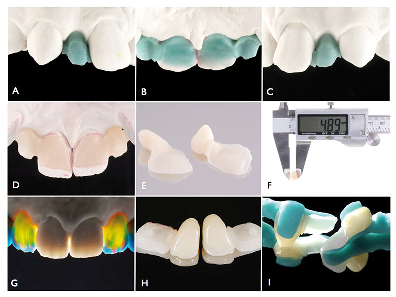 Le bridge collé cantilever – L'Information Dentaire