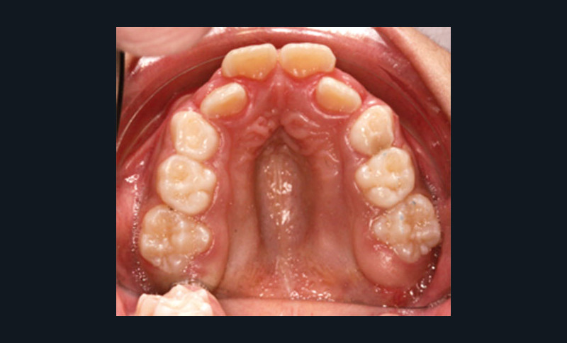 Orthodontie et SAOS pédiatrique – L'Information Dentaire