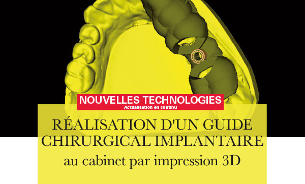 Réalisation d’un guide chirurgical implantaire au cabinet par ...