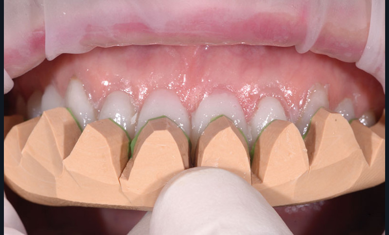 La séance de mock-up – L'Information Dentaire