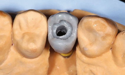 Prothèse implantaire transvissée tout céramique collée sur embase ...