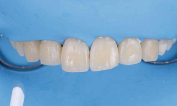 Traitement des leucomes apparus lors des thérapeutiques orthodontiques ...