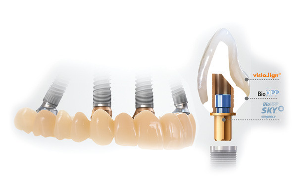 Piliers et implants – L'Information Dentaire