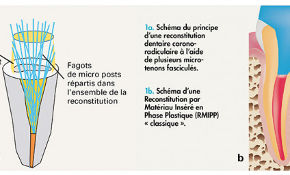 Reconstitution corono-radiculaire fibro-architecturée – L'Information ...
