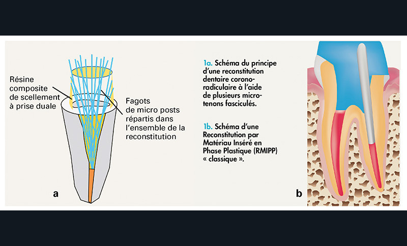 Reconstitution corono-radiculaire fibro-architecturée – L'Information ...