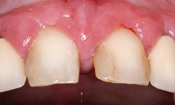 À propos d’un cas d’œdème labial pas toujours si simple… – L ...