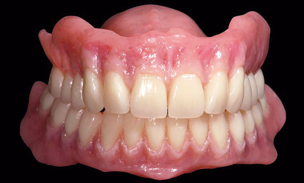 Protocole de réalisation d’une prothèse complète bimaxillaire par CFAO ...