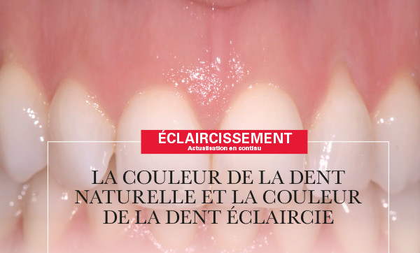 La couleur de la dent naturelle et la couleur de la dent éclaircie – L ...
