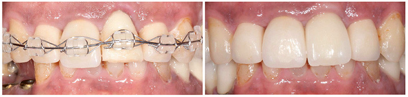 Attitude de l’orthodontiste face aux dents permanentes traumatisées – L ...