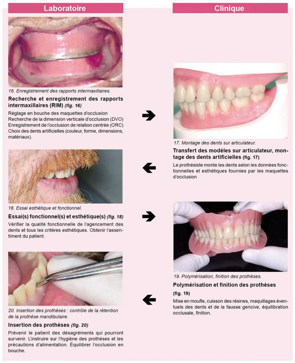 La prothèse amovible complète – L'Information Dentaire