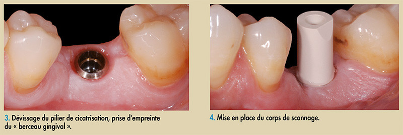 L’empreinte optique intra-orale en prothèse implantaire – L'Information ...