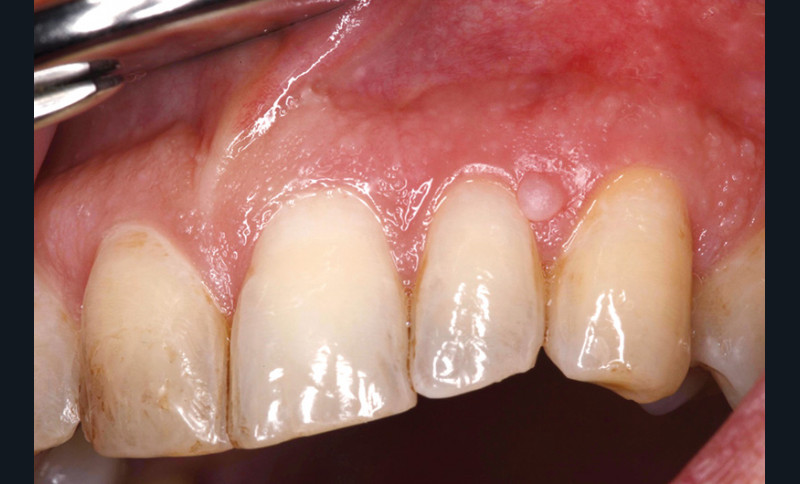 Épulis et autres tumeurs gingivales – L'Information Dentaire