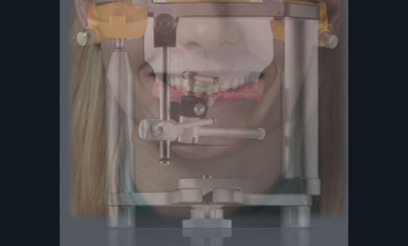 Le gradient prothétique de la dent unitaire – L'Information Dentaire