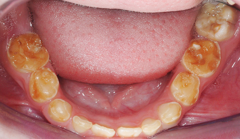 La MIH en pratique – L'Information Dentaire