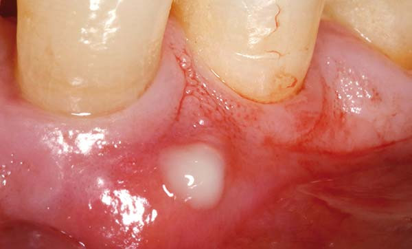 La prise en charge en urgence de l’abcès parodontal – L'Information ...