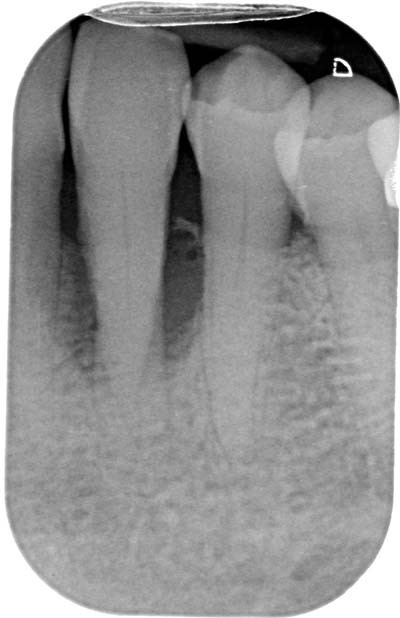 La prise en charge en urgence de l’abcès parodontal – L'Information ...