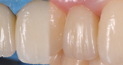 Bridge collé en extension – L'Information Dentaire