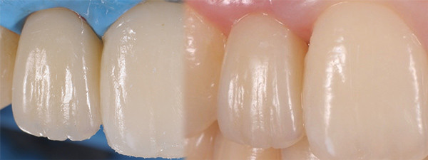 Bridge collé en extension – L'Information Dentaire