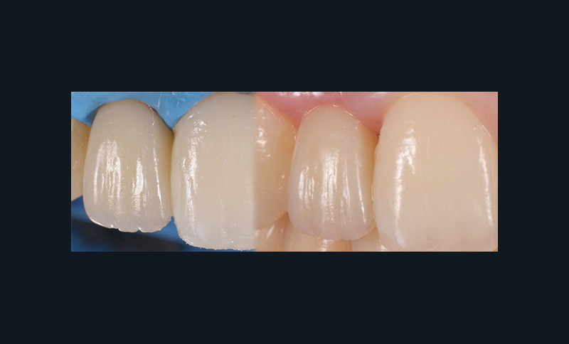 Bridge collé en extension – L'Information Dentaire