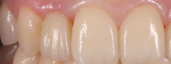 Bridge collé en extension – L'Information Dentaire