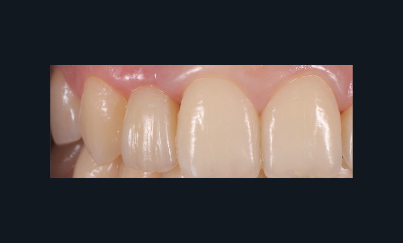 Bridge collé en extension – L'Information Dentaire